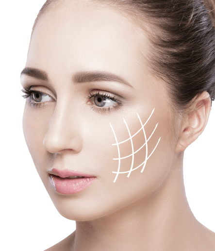 Training - V Soft Lift